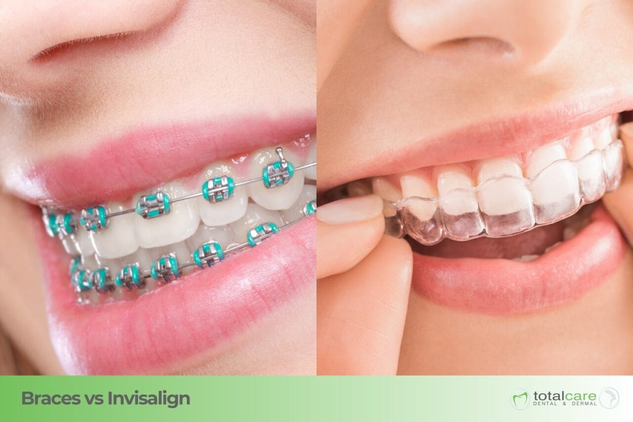 Braces vs Invisalign - The Pros and Cons