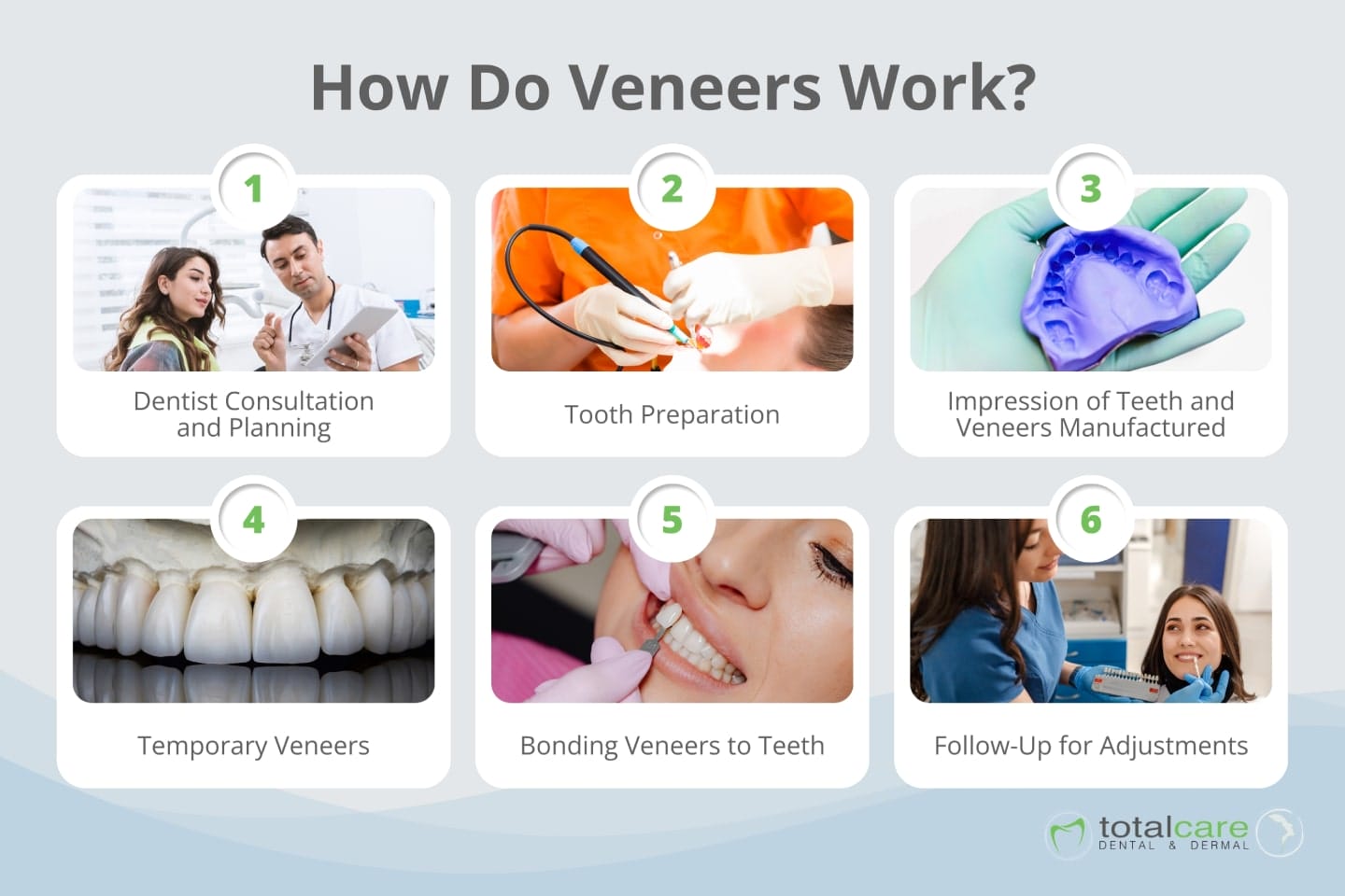 What are Veneers? Benefits, Procedure, Costs, and Results